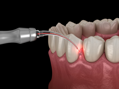 LANAP® Laser Periodontal Surgery in Wayne, NJ | Dr. Bruce Fine
